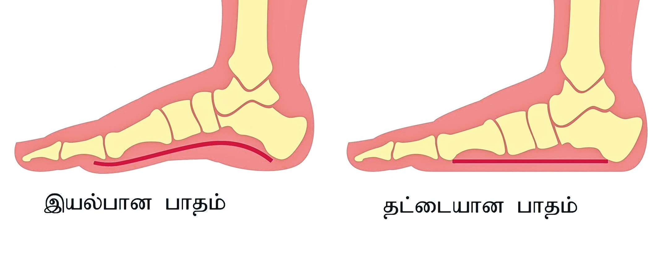 தட்டையான பாதம்: பாதிப்பும் தீர்வும், வாழ்வும் வளமும் - தமிழ் முரசு Life ...